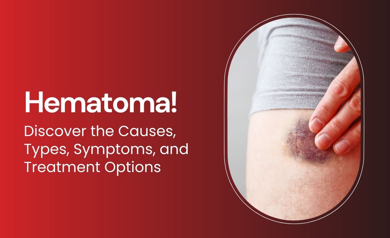 Hematoma Causes Types Symptoms And Treatment Explained